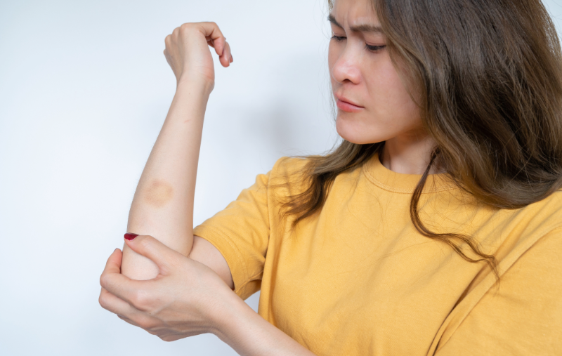 How to Best Treat Scrapes and Bruises | Bucktail Medical Center