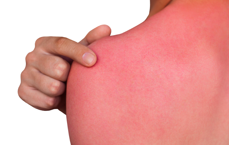 Sunburn Prevention Tips and What to Do If You Get Severe Sunburn ...